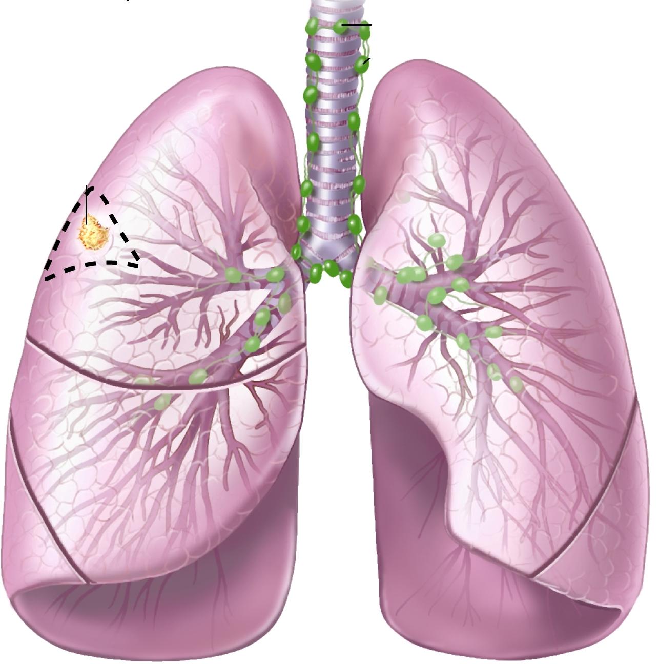 Lung Cancer Mutation Responsive Discovery | American Health Council